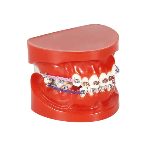 Treatment Case With Fixed Braces (Abnormal) | Dentalshop Com