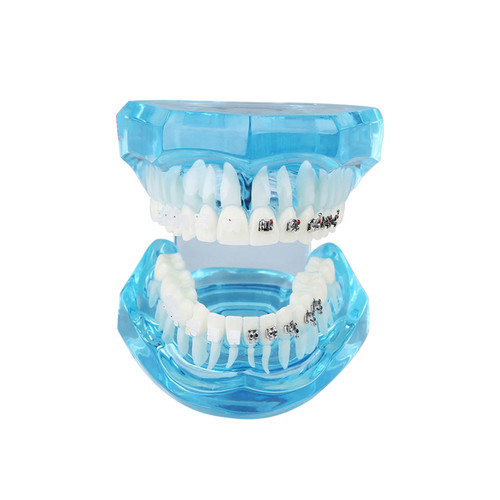DS-B21 Transparent Dentition With Brackets | Dentalshop Com