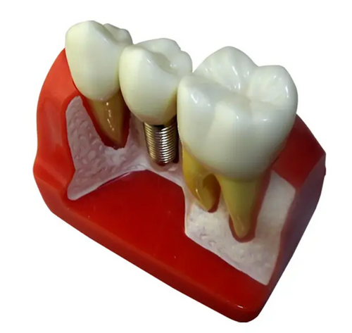 Implant Model for Doctor-patient Communication Use | Dentalshop Com