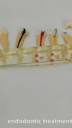 5 Stages Demonstration Model for Endodontic Treatment | Dentalshop Com