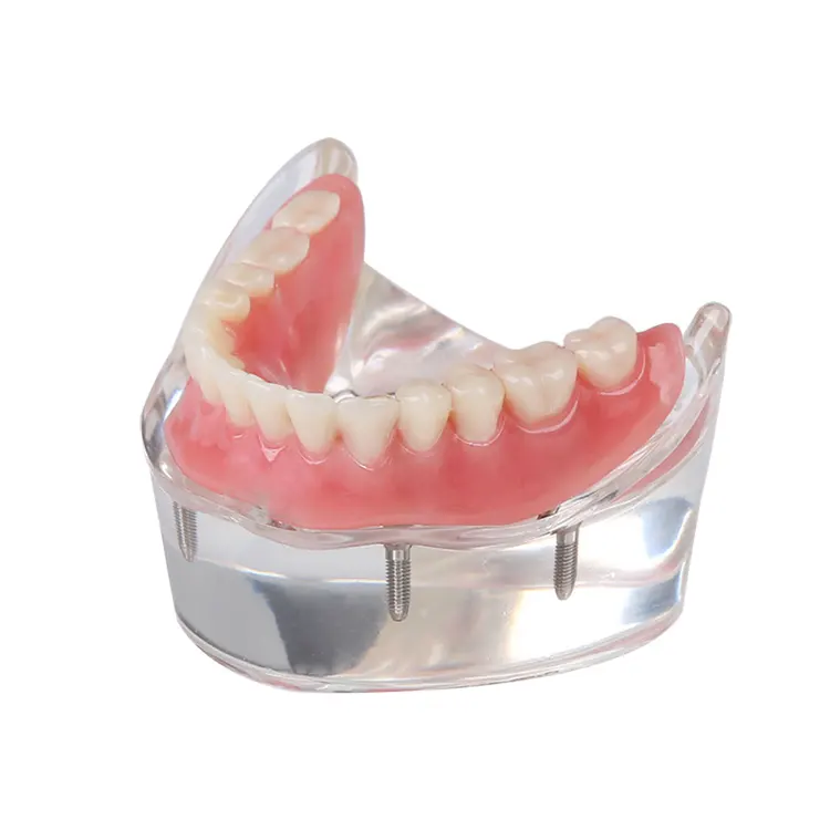 Mandibular overdenture implant teeth model with 4 implants | Dentalshop Com