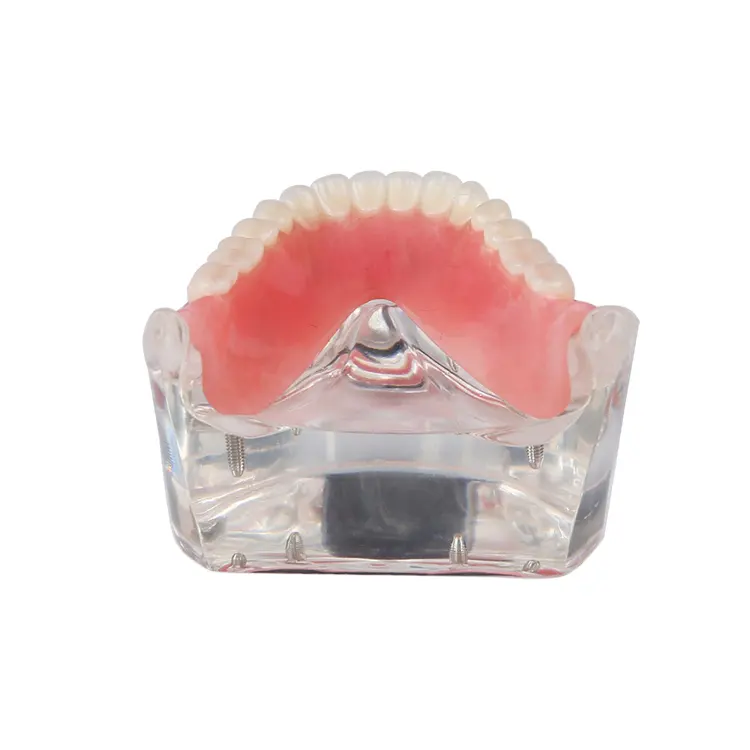 Mandibular overdenture implant teeth model with 4 implants | Dentalshop Com