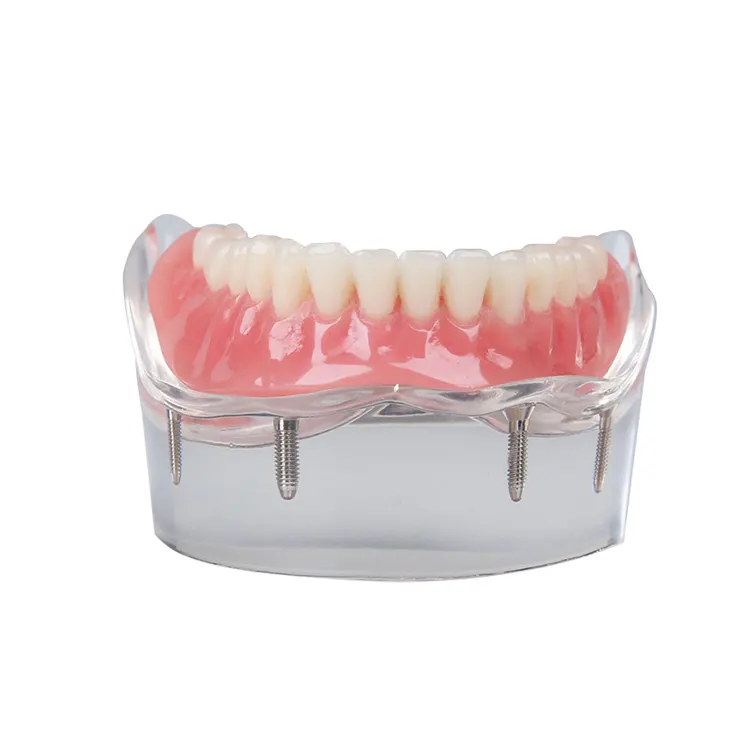 Mandibular overdenture implant teeth model with 4 implants | Dentalshop Com