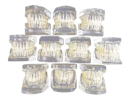 Transparent Ortho Classification Dental Teaching Orthodontic Model Set ...