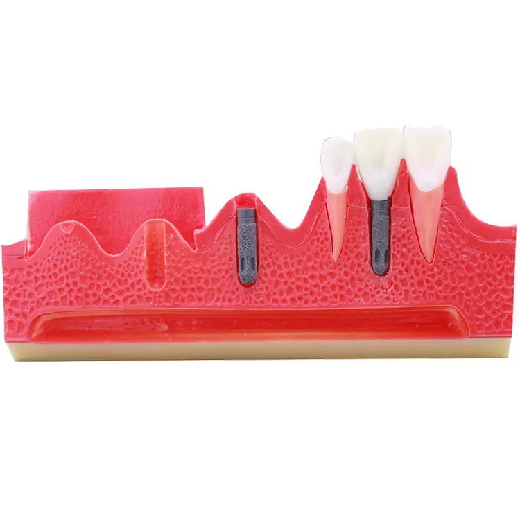 Implant Step Dental Model For Student Practice | Dentalshop Com
