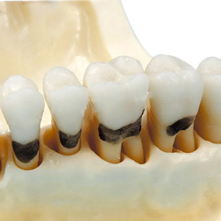 Dental Periodontal Practice Model for Demonstrating Calculus and ...