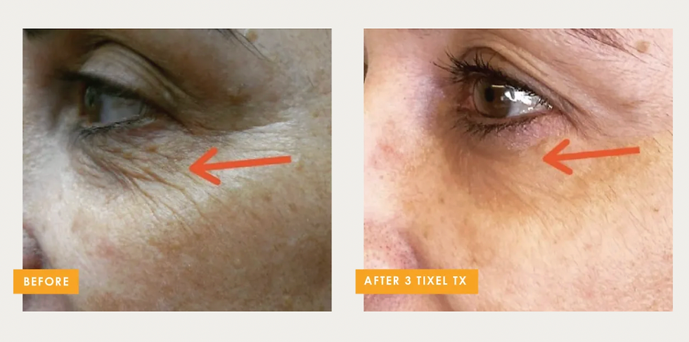 Tixel i: A New, Advanced Treatment for Dry Eye Disease in Boston