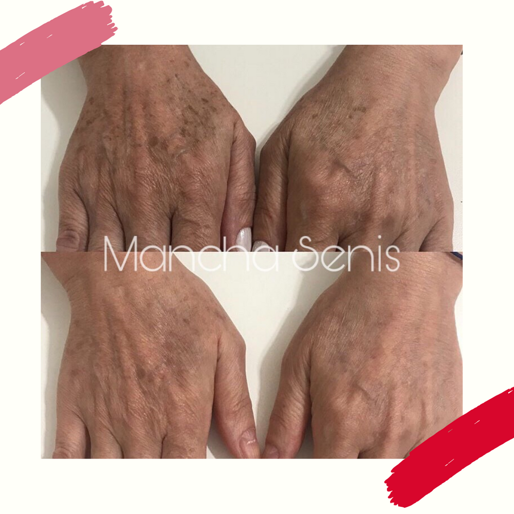 "Manchas Senis" O que é? Qual melhor tratamento?