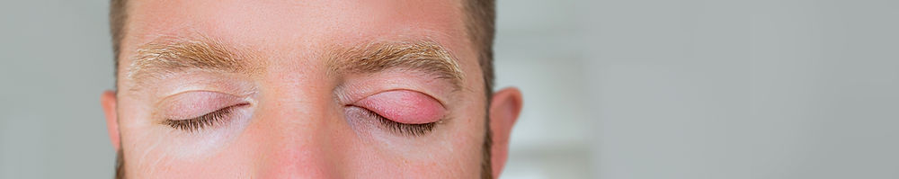 What’s a Stye? The Eye-Catching Truth About Those Pesky Lumps