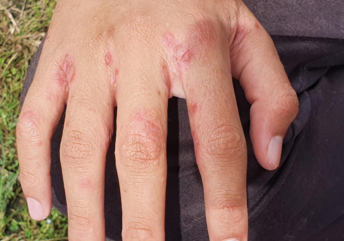 Viktigt att veta om skabb & behandling | Läka & Knodd