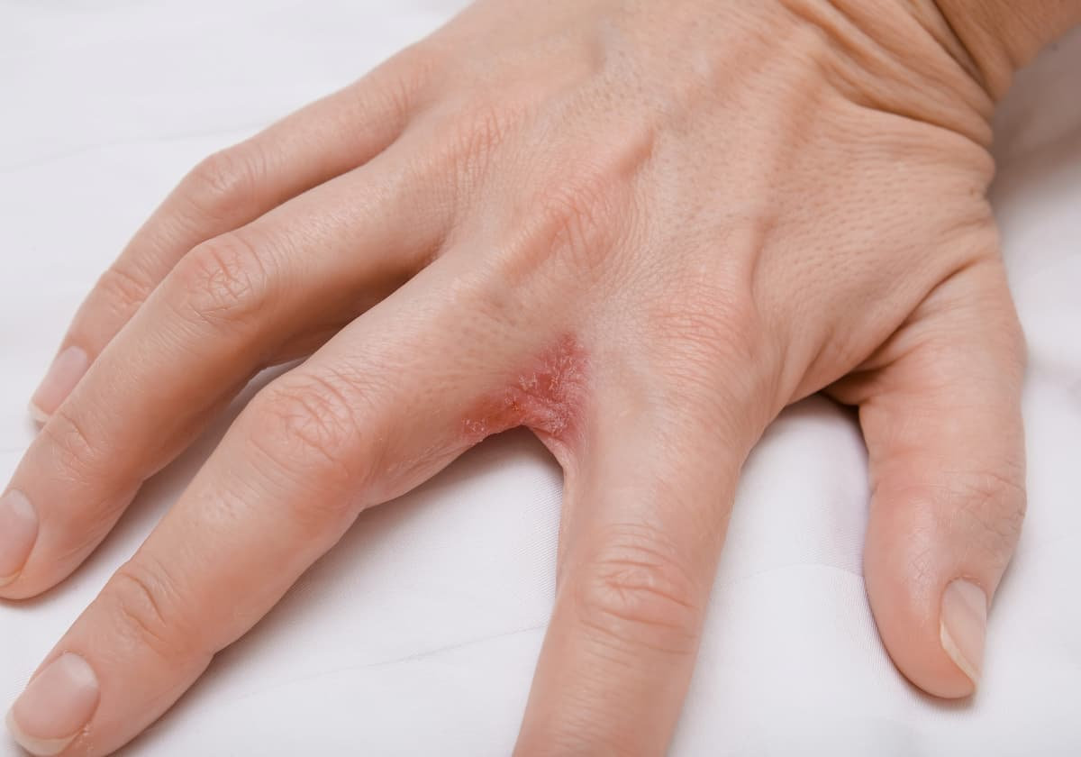 Viktigt att veta om dyshidrotiskt eksem (pomfolyx) | Läka & Knodd