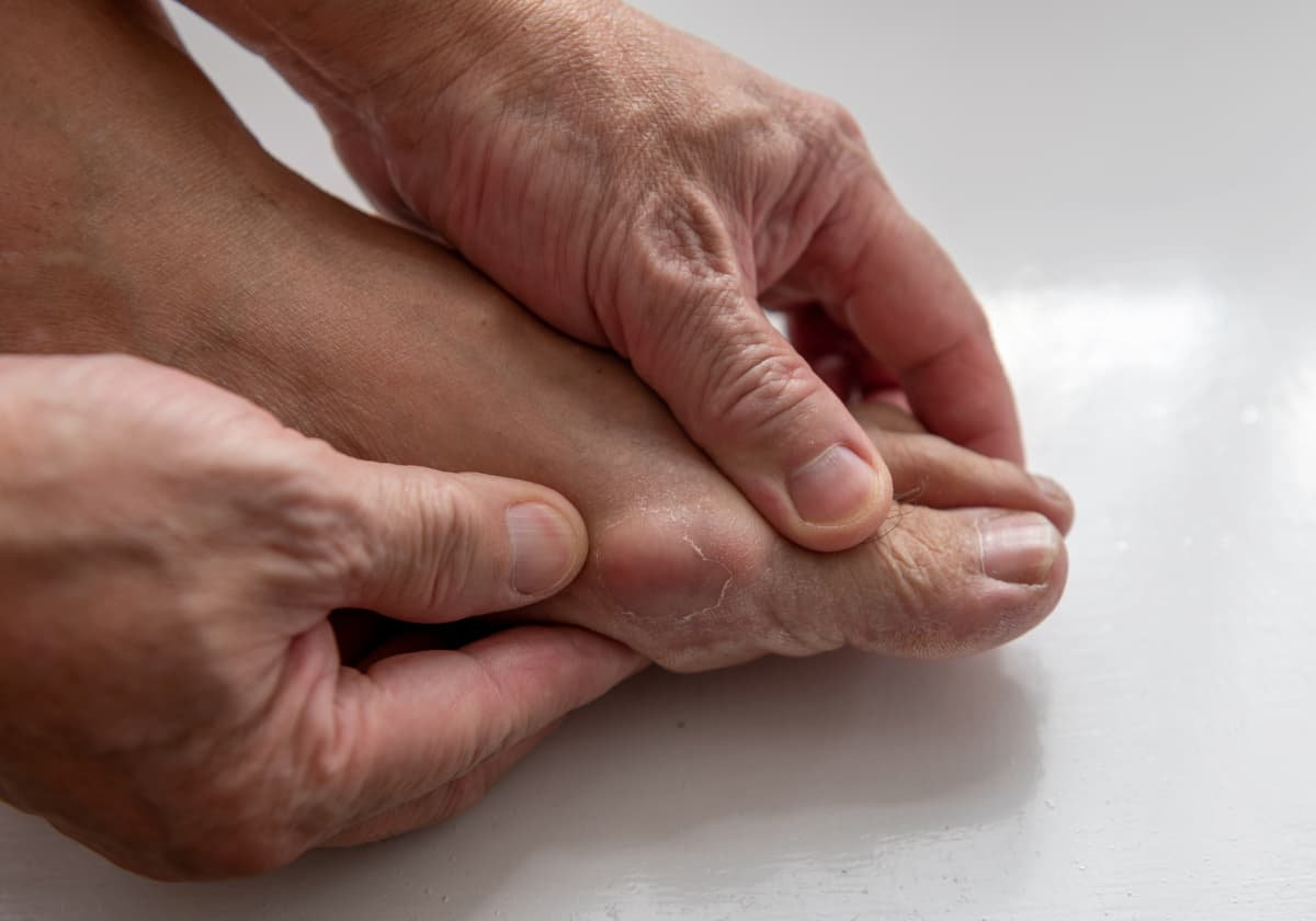 Viktigt att veta om gikt (portvinstå) | Läka & Knodd