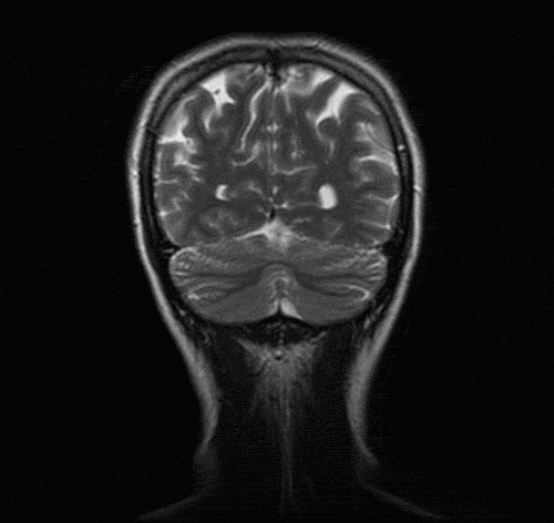 Ressonância Magnética :: Neurociência