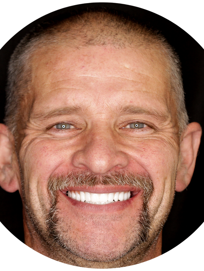 Full Mouth Dental Implants Nationwide