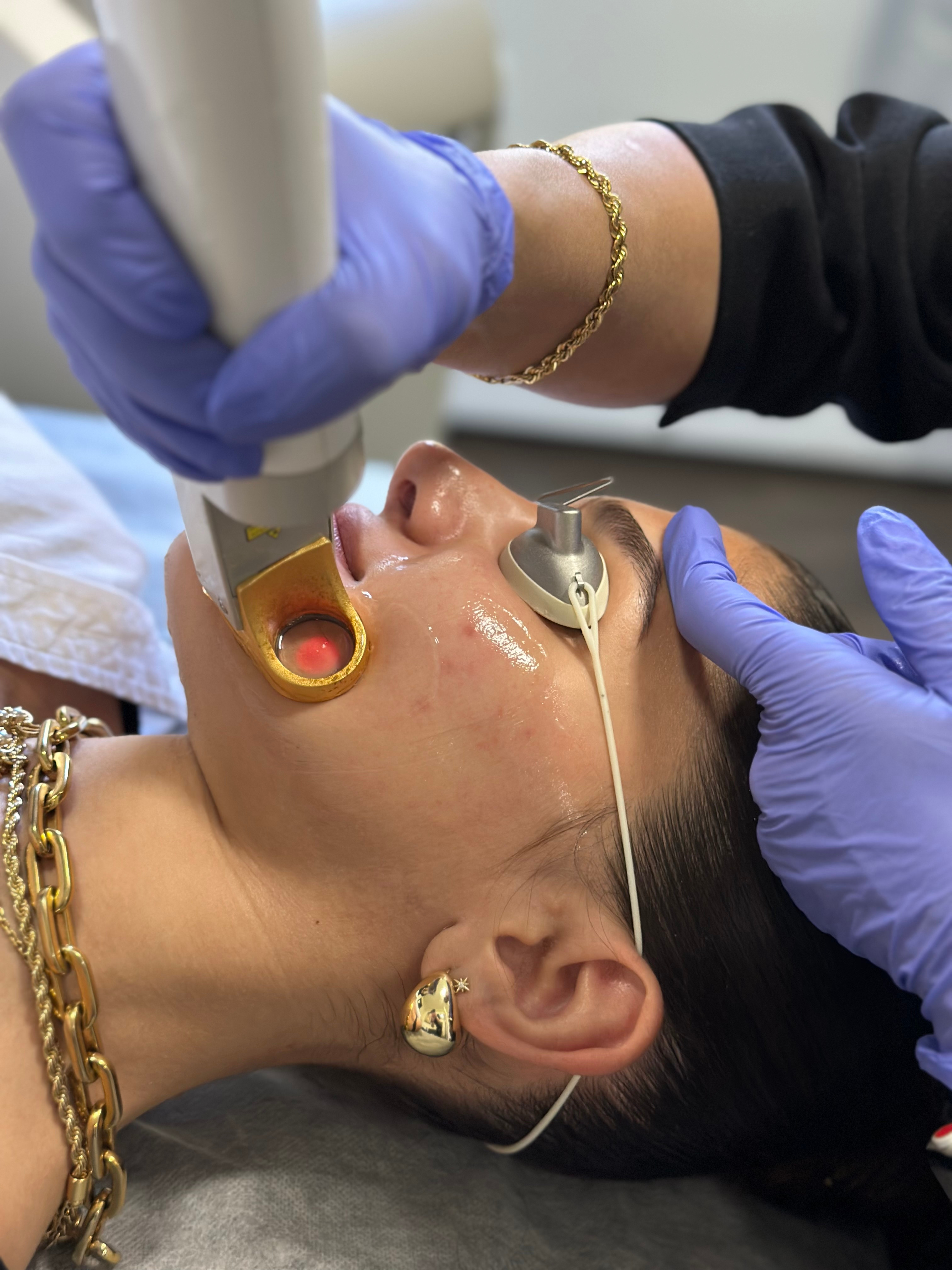 Acne Laser