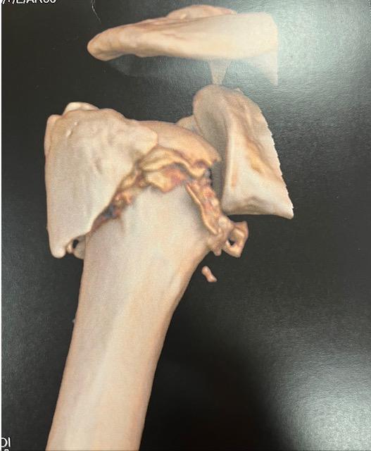 SHOULDER FRACTURES