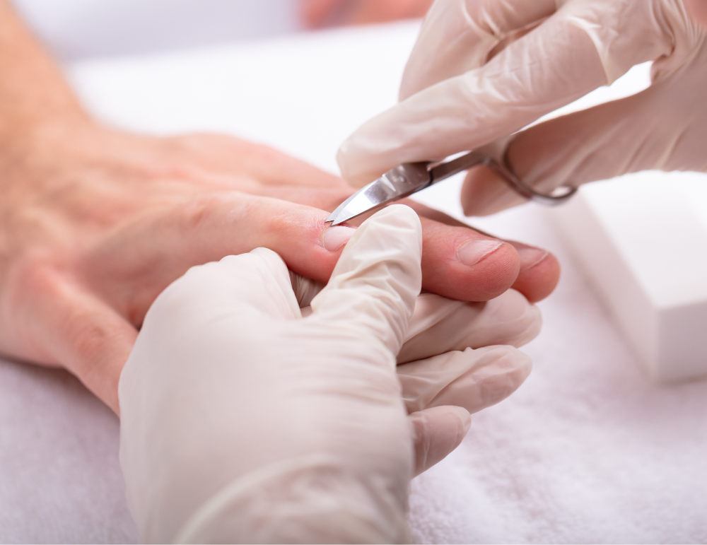 Finger Nail Cutting at the Care-Feet Clinic | Chelmsford, Essex UK
