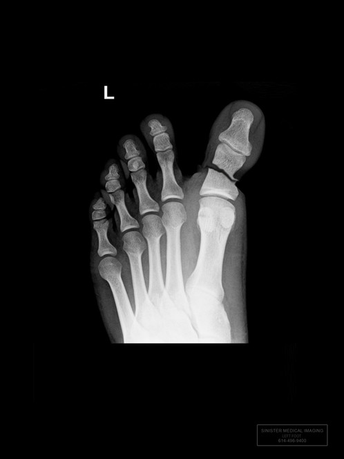LEFT FOOT BROKEN BIG TOE X-Ray