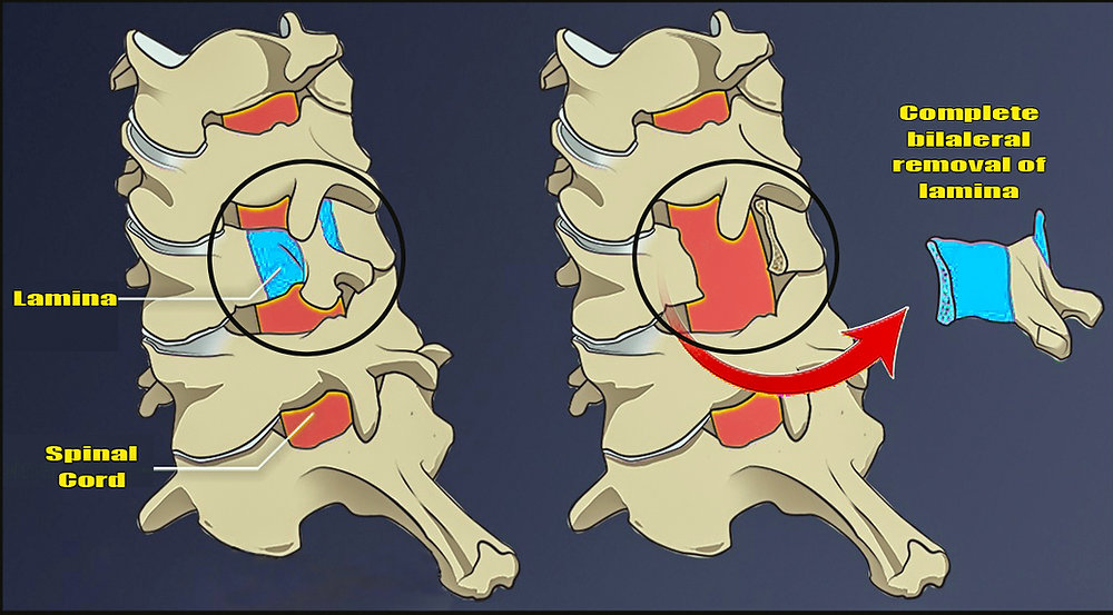 Laminectomy vs Laminotomy? Avoid Both With Non-surgical Spinal ...