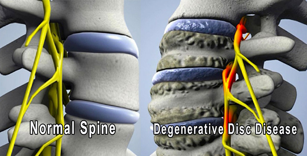 Non-Surgical Solutions for Degenerative Disc Disease in Cary, NC