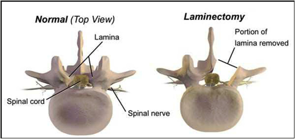 Laminectomy vs Non-Surgical Spinal Decompression: What You Need to Know!