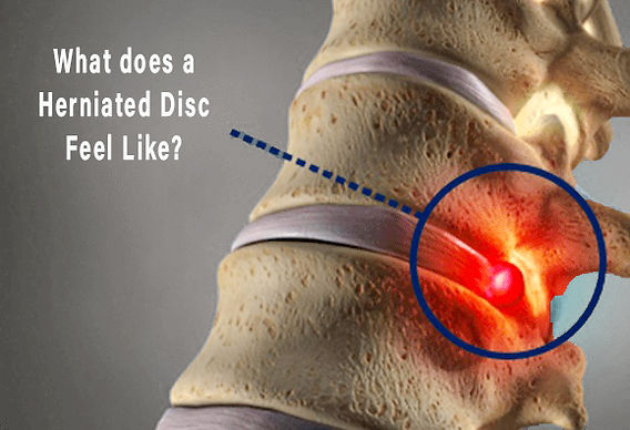 herniated disc neck causes