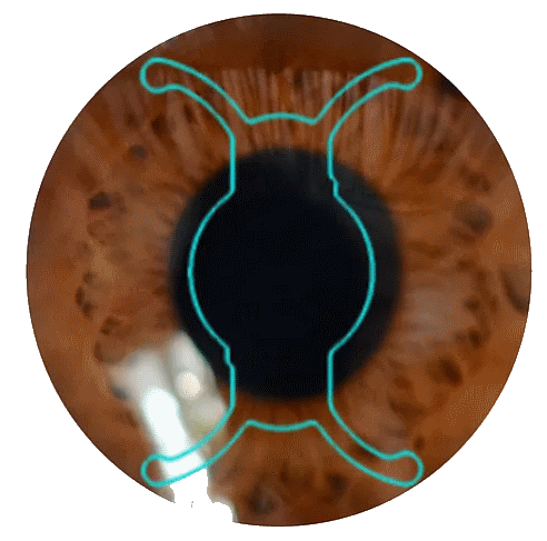 NO GLARE NO HALO EDOF LENS | ophtalcare