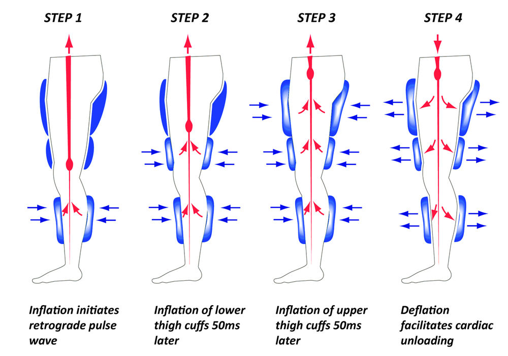 Discover EECP - The Natural Bypass