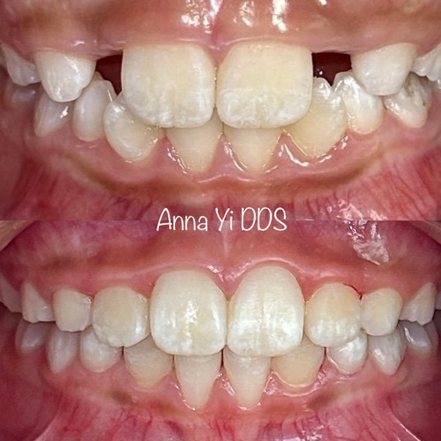 Invisalign First Success: A Smile Unlocked in Just 8 Months!