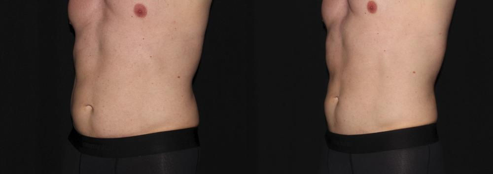 EM SHAPE X - Mit Magnetwellen zur Traumfigur! Revolution im Bodyforming