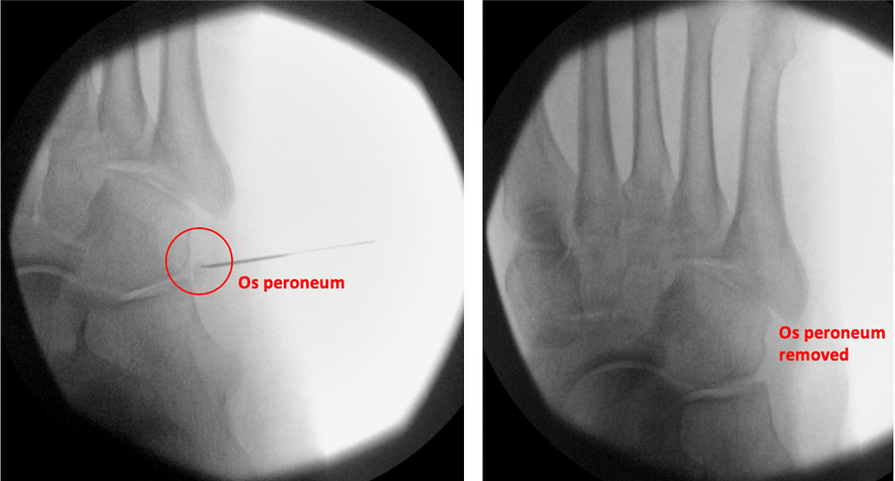 Case Discussion: Lateral Foot Pain Secondary to Os Peroneum