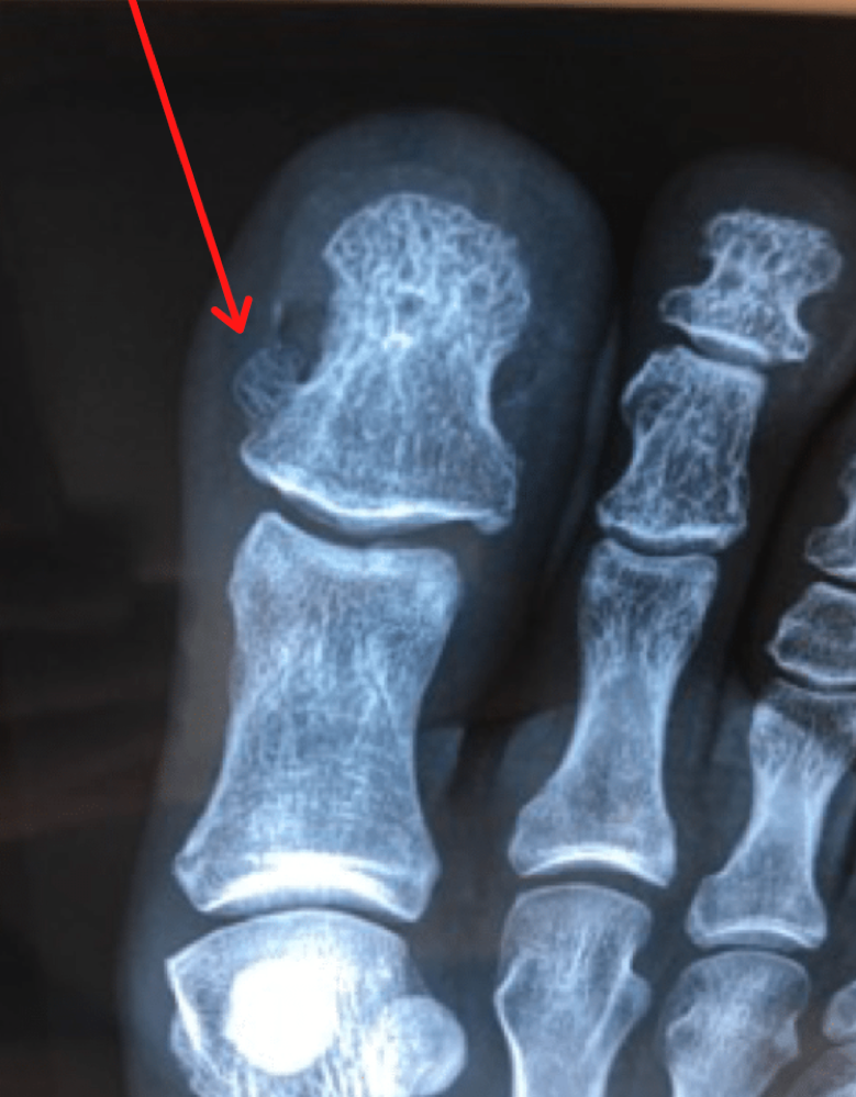 A 40 year old lady with rare fungal bone infection as cause of chronic ...