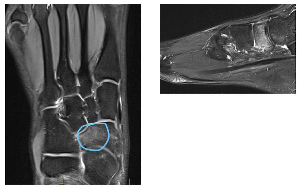 Case Discussion: 18 Year Old With Bilateral Navicular Stress Fractures