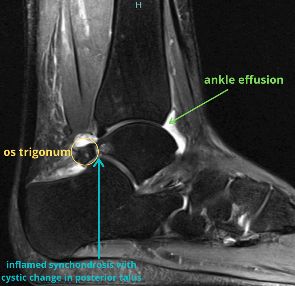 Case of the Week #16: A symptomatic os trigonum in a 32yo lady.