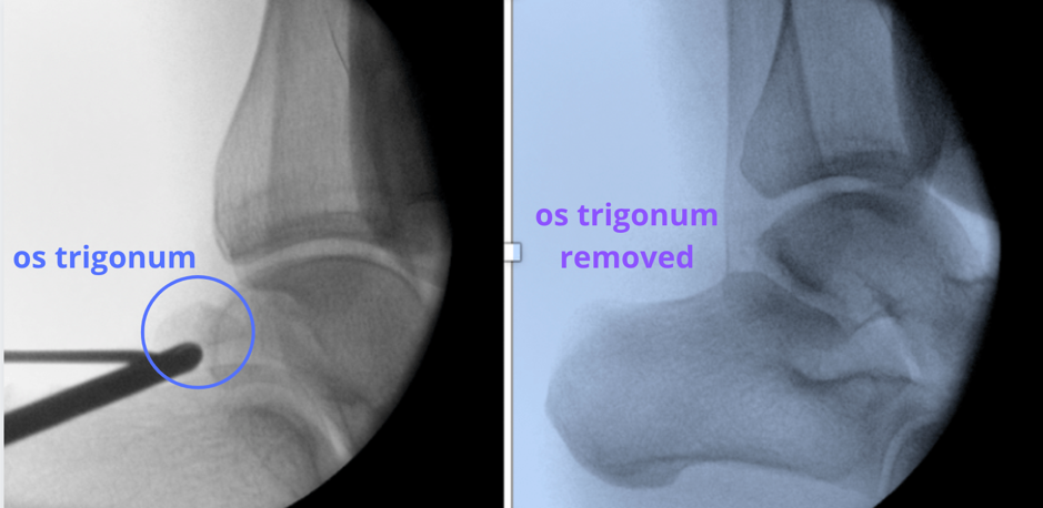 Case of the Week #16: A symptomatic os trigonum in a 32yo lady.