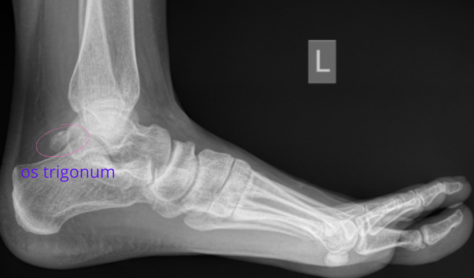 Case Discussion: A Symptomatic Os Trigonum in a 32yo Lady