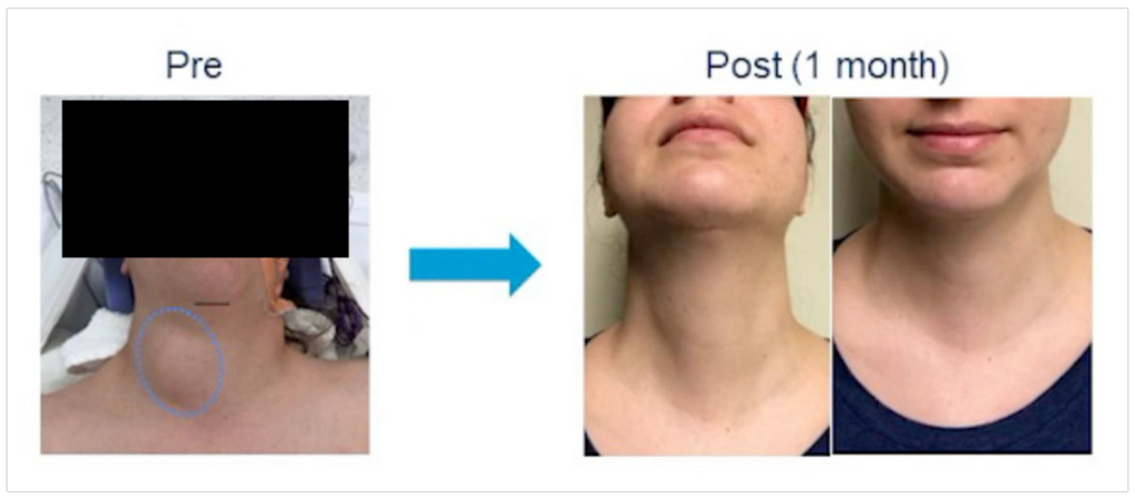 Transoral Thyroid and Parathyroid Surgery News | scarlessthyroid.org