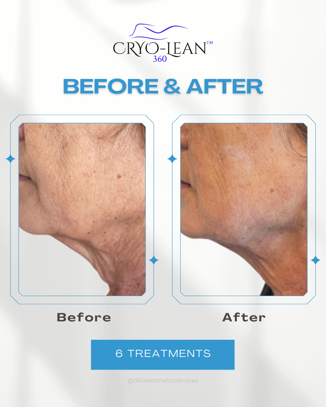 CRYO-LEAN 360 | Zen Space Wellness S