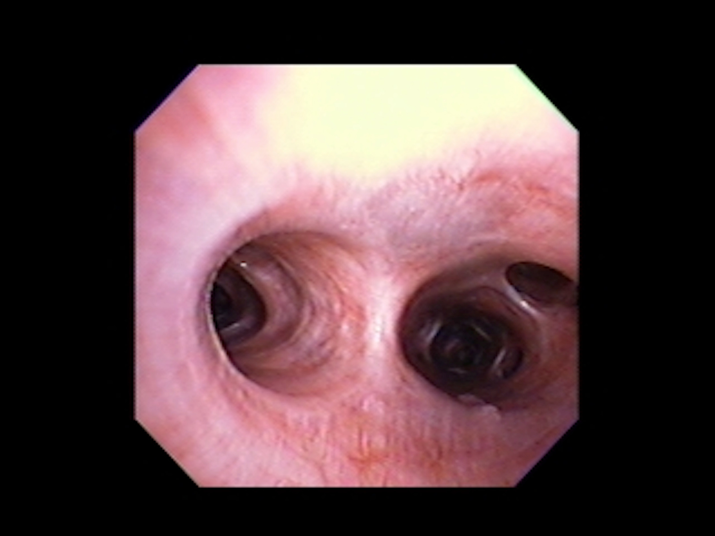 normal abnormal bronchoscopy