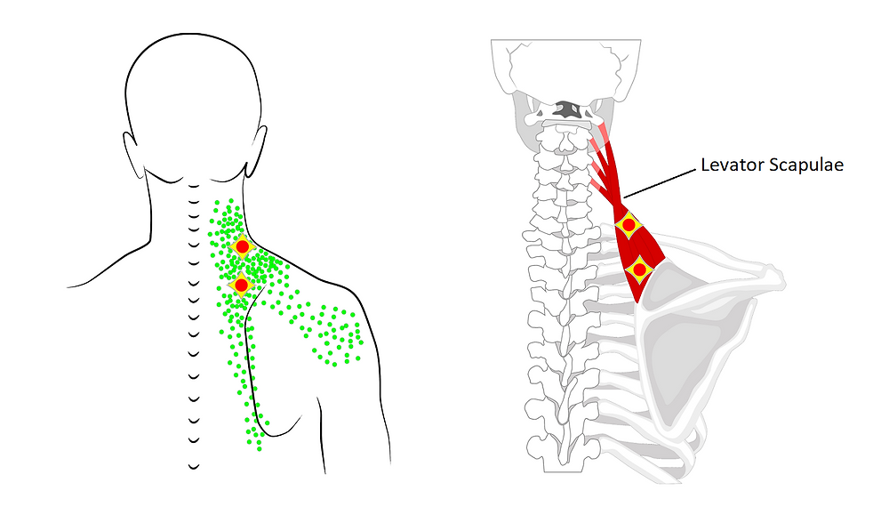 Levator Scapulae Pain Relief: The Role of Trigger Point Massage