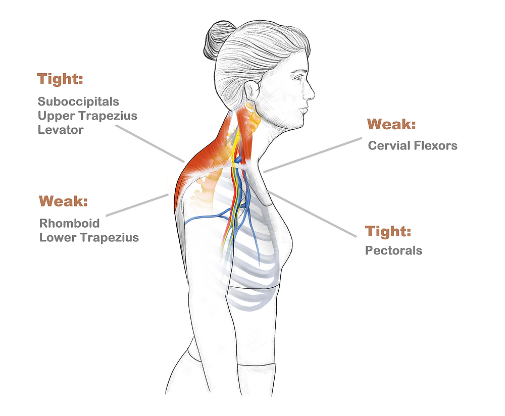 Massage Therapy Techniques For Thoracic Outlet Syndrome At Kevin Massage Therapy Techniques For Thoracic Outlet Syndrome At Kevin