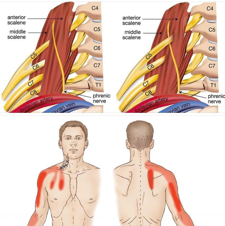 Tingling? Numbness? Where is it coming from? Spine? Shoulder? Neck ...