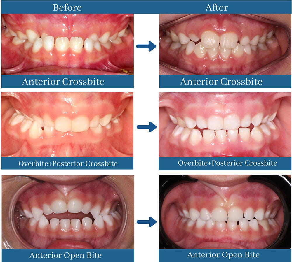 Understanding Malocclusion in Growing Children: Causes, Effects, and ...