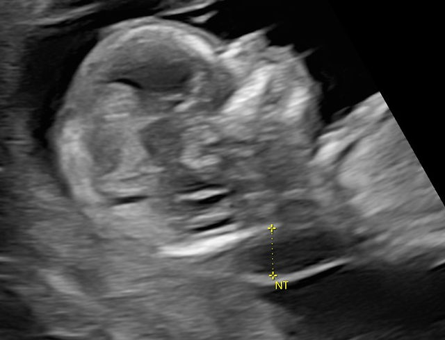 Increased Fetal Nuchal Translucency Thickness And Normal 54 Off