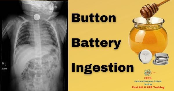 Button Battery Ingestion