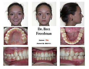 crowded teeth braces without extraction