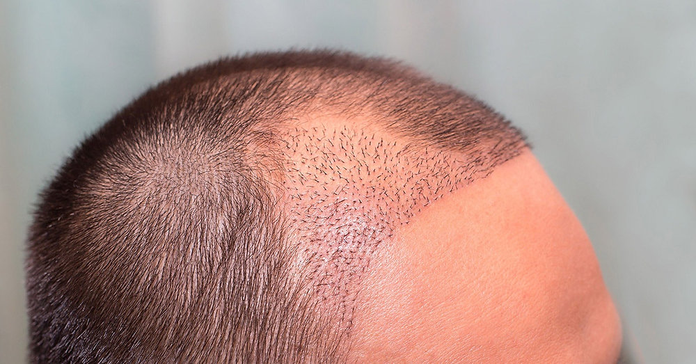 Advanced FUE Hair Transplant Without Scar Solutions