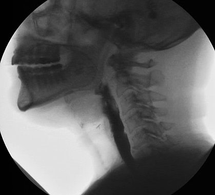 MBS Imaging | Mobile Dysphagia Diagnostic Solutions | MOBILE MODIFIED ...