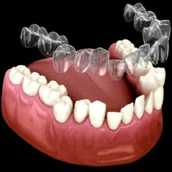 Understanding the Different Types of Dental Retainers Available in Dubai