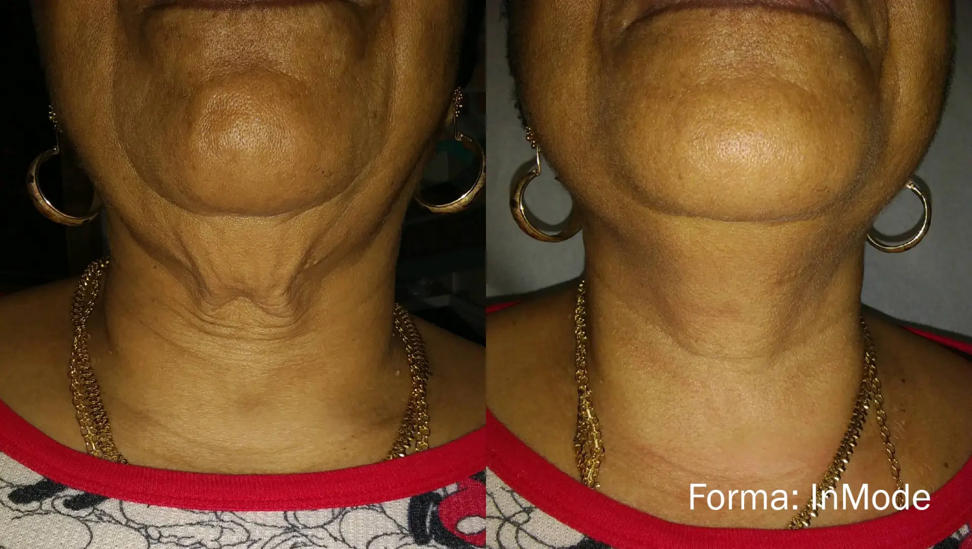 FORMA (FACE) | Timeless MediSpa